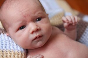 Rodin ugriz kod beba uzrok i lečenje – Dijeta plus